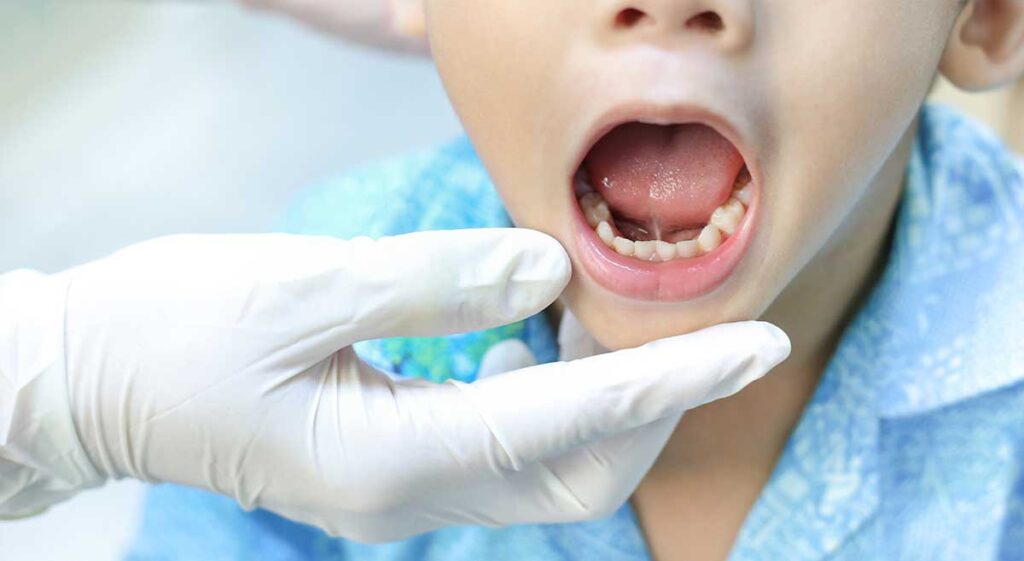 Symptoms Of Tongue Tie Tpi Therapeutic Potential Inc